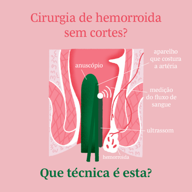 Quem são as famosas hemorroidas? - Dra. Aline Celeghini ...